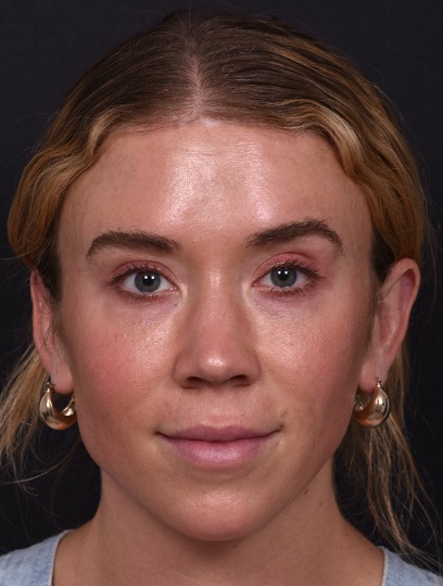 Photofacial / IPL Case 18657 - Aviva Plastic Surgery