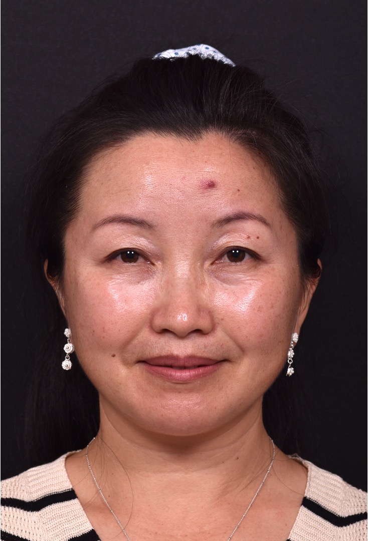 Moles & Skin Lesions Case 18927