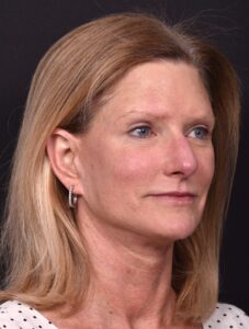 Brow Lift Before & After Gallery - Aviva Plastic Surgery