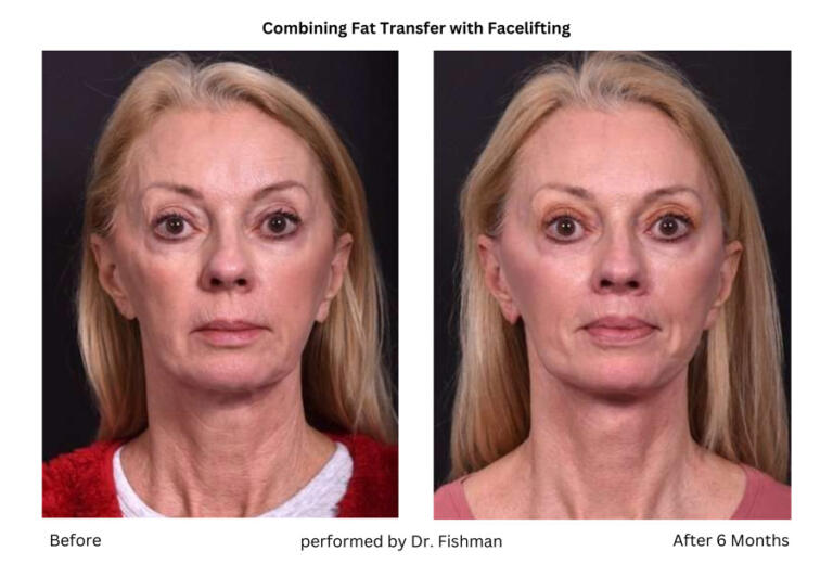 Lift and Fill: Combining Fat Transfer with Facelifting for Best Results
