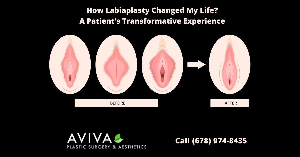 Labiaplasty Procedure Before And After Labiaplasty Procedure Before And After