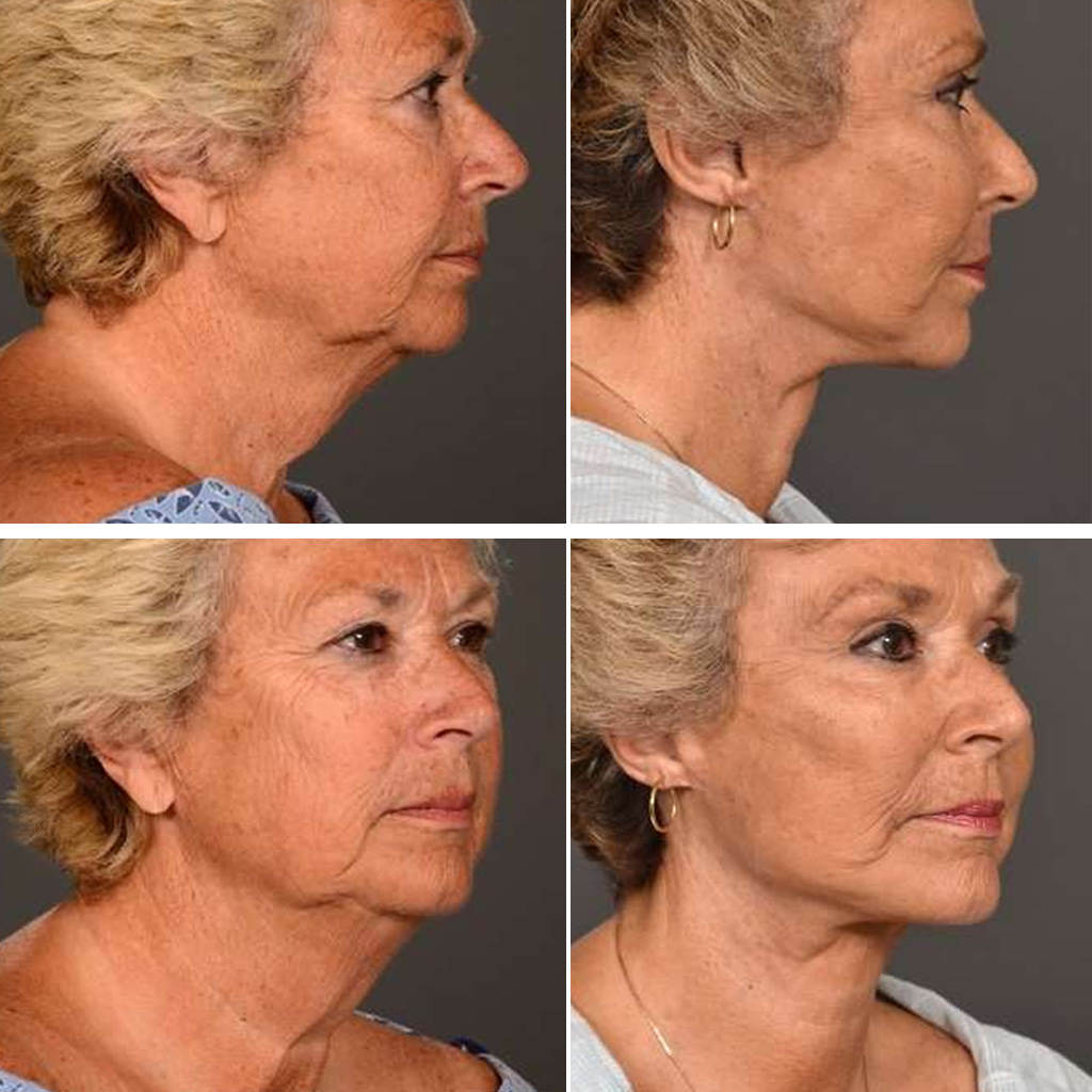 Face Lift Surgery in Atlanta | Dr. Inessa Fishman | Natural, Lasting ...
