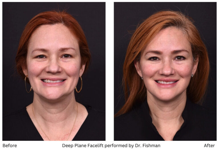 Facelift in Your 40s: Ideal Time for Natural Rejuvenation