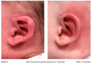 EarWell Infant Ear Molding: Non-Surgical Newborn Ear Correction