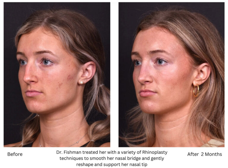 Precision Nose Reshaping with Piezo Technology