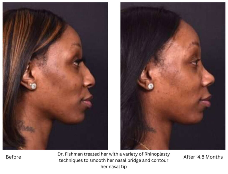 Precision Nose Reshaping with Piezo Technology