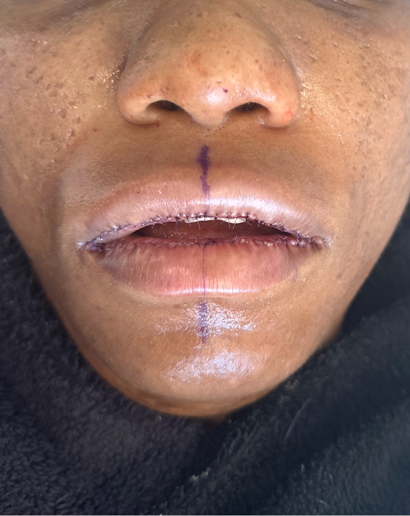 Lip Reduction Case 25417