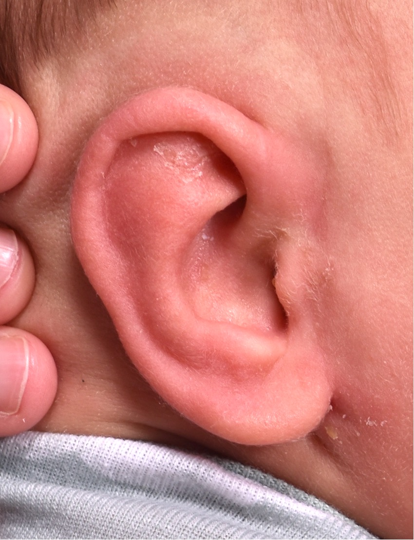 Newborn Ear Correction Case 25654