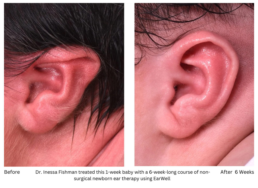 Newborn Ear Shaping Without Surgery: EarWell vs. InfantEar