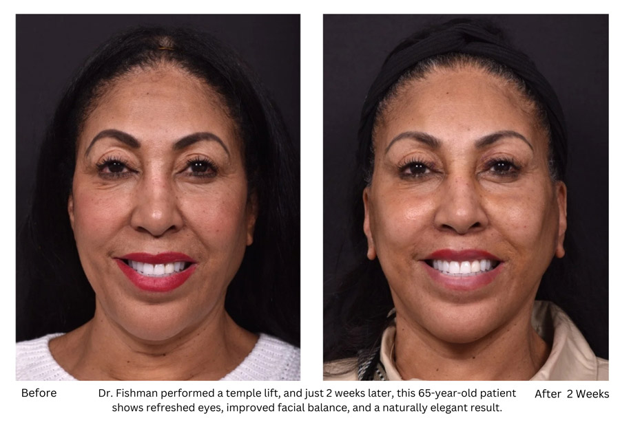 Restore Your Expression: When It’s Time for a Brow Lift